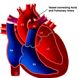 LEFT TO RIGHT SHUNT LESIONS - RME